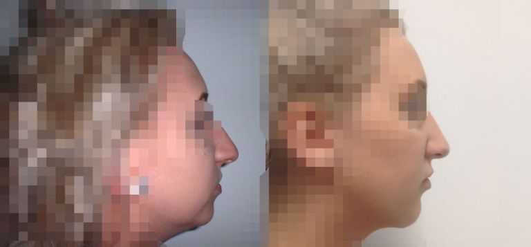 Operative Kinnkorrektur - Keck Ästhetik