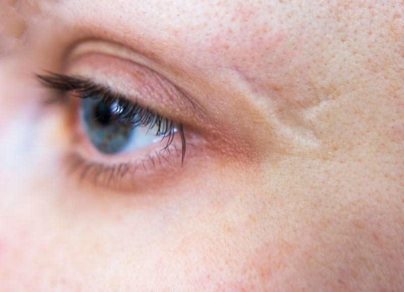 Operative Narbenkorrektur - Keck Ästhetik